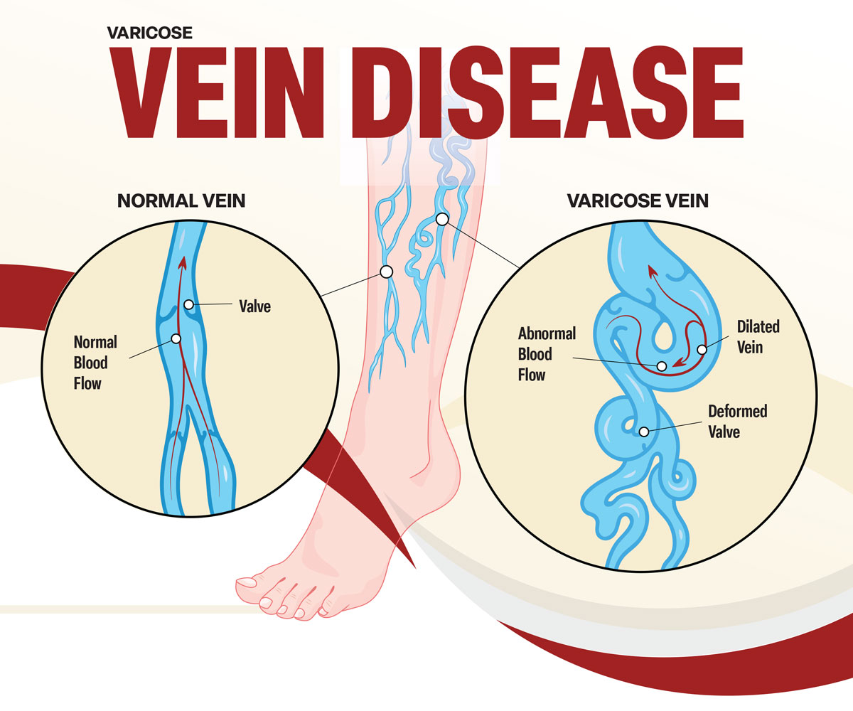 Varicose Veins - CV Experts of Central Pennsylvania - The Best ...